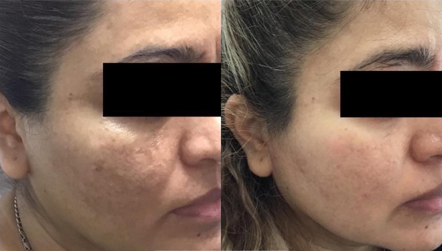 Topical Treatment for Melasma Before & After Photos Patient 43 ...